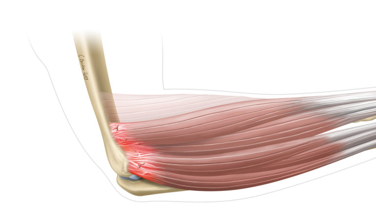 L'EPICONDYLITE - LA TENDINITE CHRONIQUE LATERALE DU COUDE - Clinique de ...
