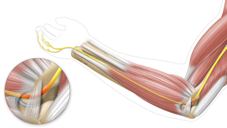 LIBÉRATION À CIEL OUVERT DU NERF ULNAIRE AU NIVEAU DU COUDE - Clinique ...