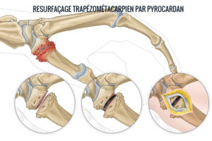 RHIZARTHROSE DE LA BASE DU POUCE-LA TRAPEZECTOMIE - Clinique de la Main ...