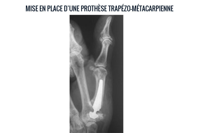 RHIZARTHROSE DE LA BASE DU POUCE-LA TRAPEZECTOMIE - Clinique de la Main ...